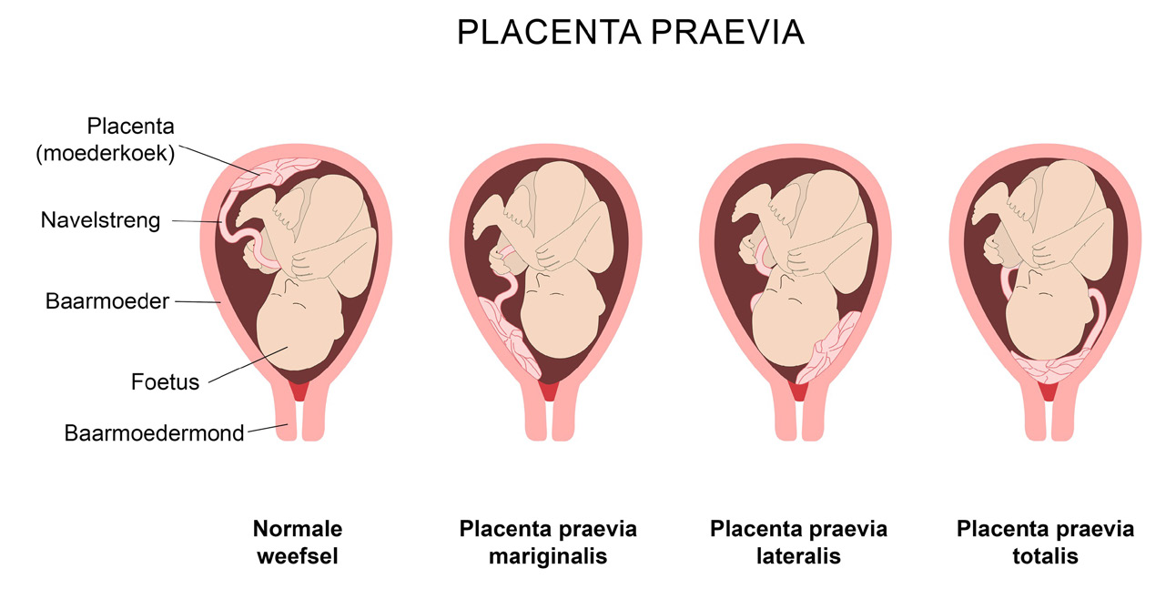 Het Van Weel-Bethesda Ziekenhuis - patiëntfolder: Placenta Praevia
